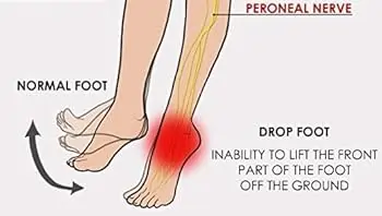 ફૂટ ડ્રોપ (Foot Drop) - કારણો, લક્ષણો, સારવાર